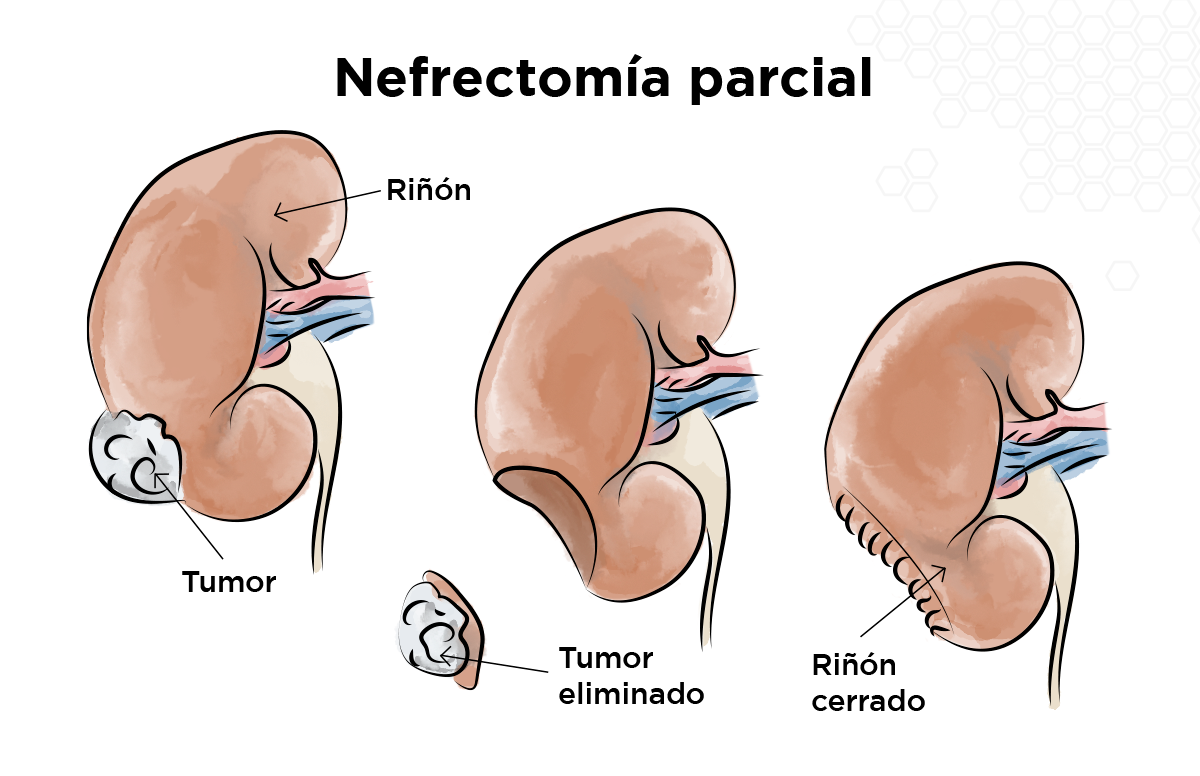 Médica Sur Da Vinci Programa De Cirugía Robótica