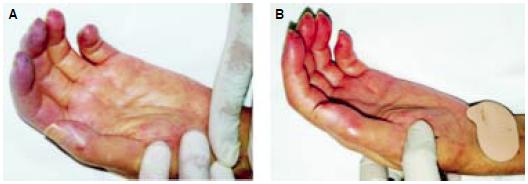 Fenómeno de Raynaud secundario en esclerodermia difusa